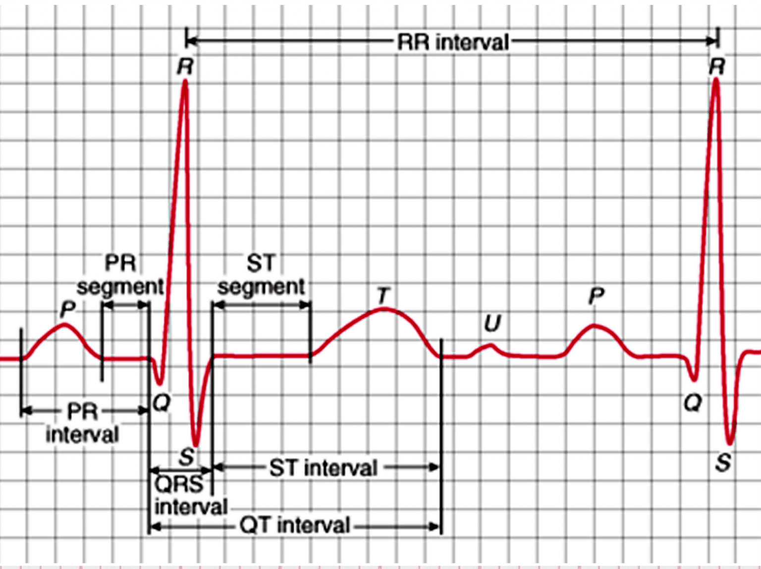 Que Représente le Signal ECG | AVF Biomedical