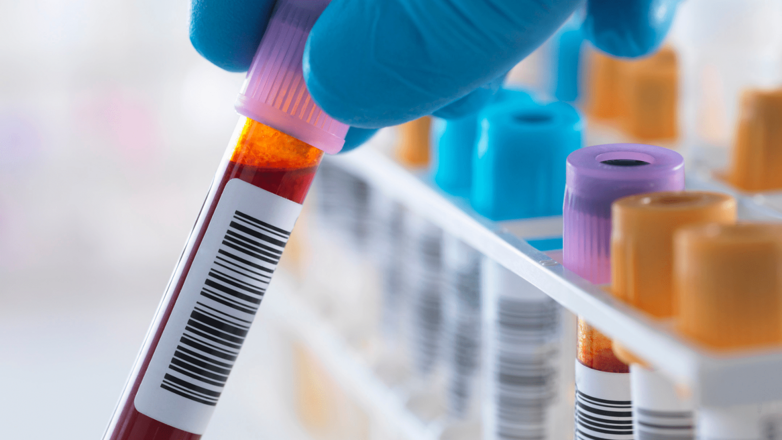 Tout Savoir Sur le Prélèvement Veineux | AVF Biomedical